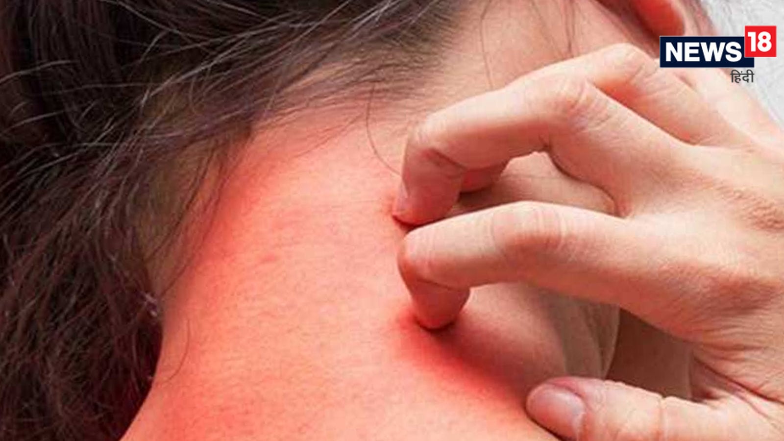 सर्दियों में होने वाली खुजली से राहत पाने के लिए अपनाएं 5 घरेलू नुस्खे ...