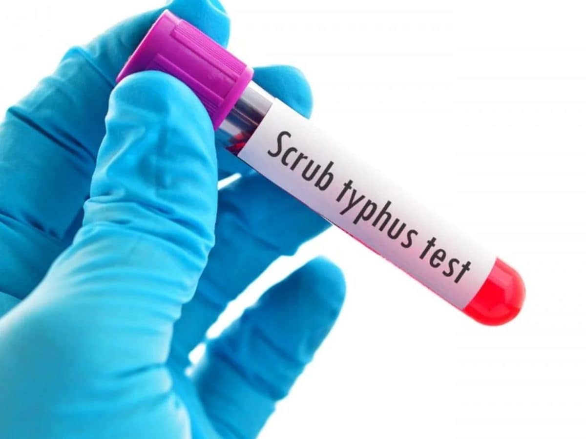 Scrub Typhus: हिमाचल में स्क्रब टायफस से पहली मौत, 54 साल के मरीज की गई ...