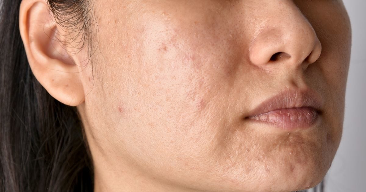 चेहरे पर कितने तरह के दाग होते है? जानिए इनके होने का कारण और इलाज ...