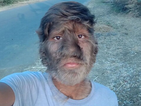 क्या है Werewolf Syndrome? जिससे भालू जैसा बन जाता है इंसानी चेहरा ...