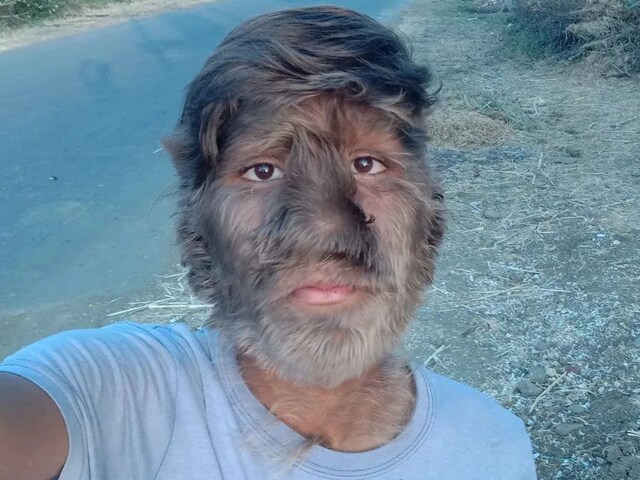 क्या है Werewolf Syndrome? जिससे भालू जैसा बन जाता है इंसानी चेहरा ...