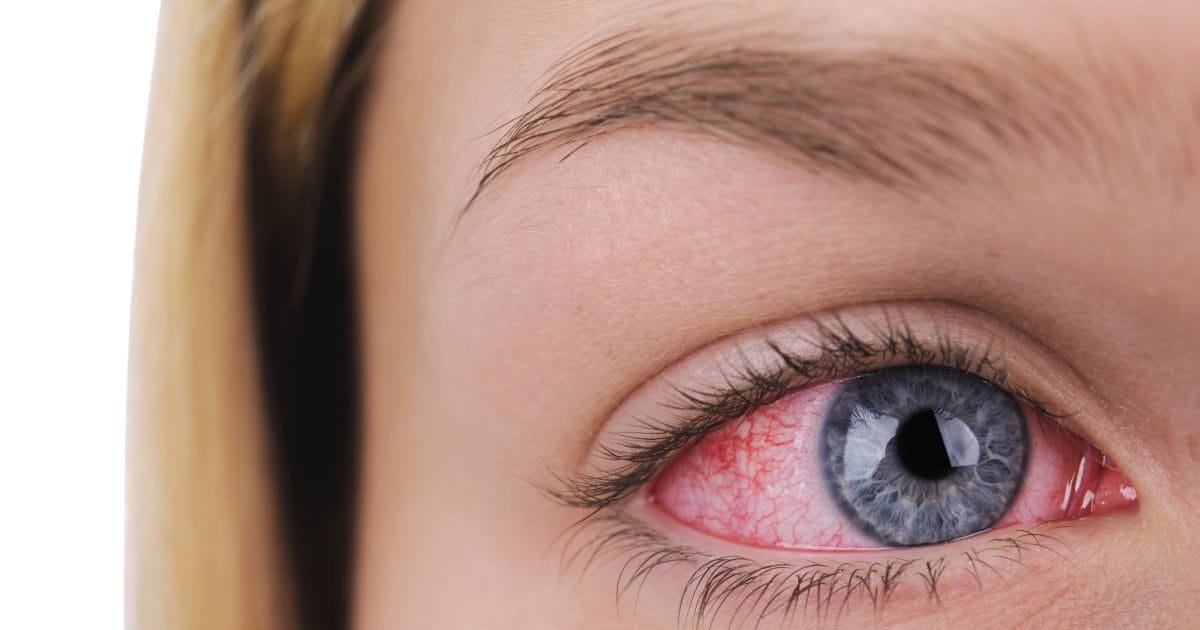 Eye redness: क्या सामान्य है हमेशा आंखों का लाल रहना? इससे राहत पाने के ...
