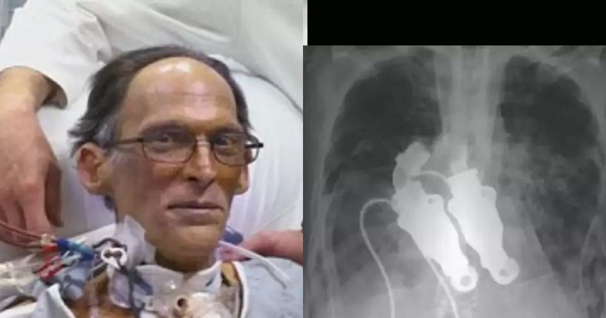 जिंदगी के बचे थे महज 12 घंटे, जान बचाने डॉक्टरों ने निकाल लिया दिल, फिर ...