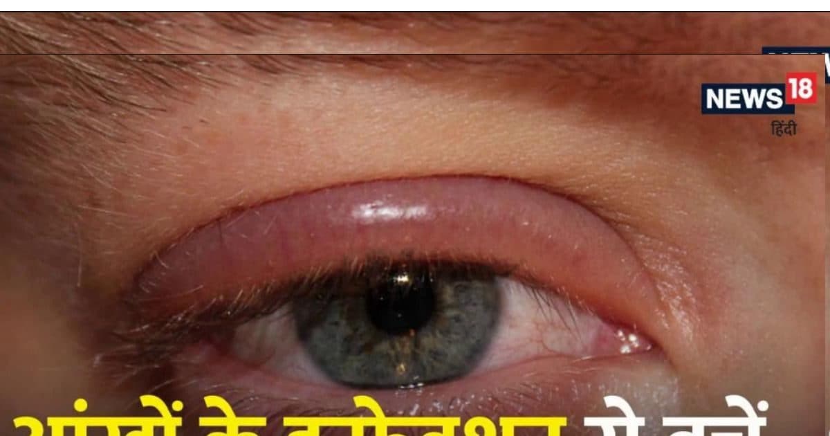 BHU में अनजान खतरा, दो और हॉस्टलों में छात्रों की आंखों में VIRUS ...