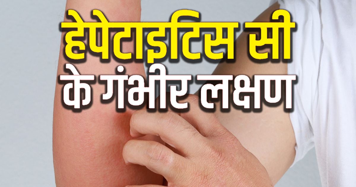 Yellow discoloration of the skin and eyes Poor appetite symptoms of ...