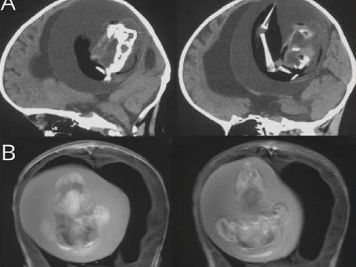 Chinese doctors removed unborn twin from baby girl brain after 1 year ...