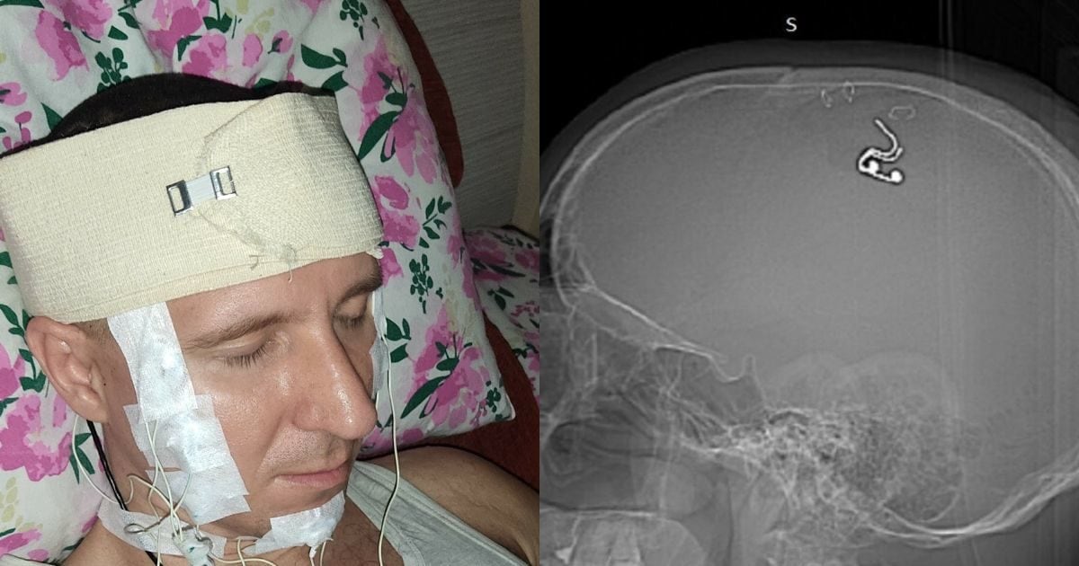 शख्स ने घर में खुद से की अपनी ब्रेन सर्जरी, ऐसा करने के पीछे था ...