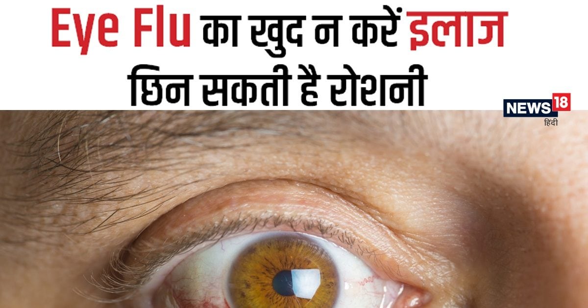 Eye Flu Drop: आई फ्लू में ये आई ड्रॉप डालने से दो मरीजों को हुआ आंख का अल्‍सर, AIIMS के डॉ. ने ...
