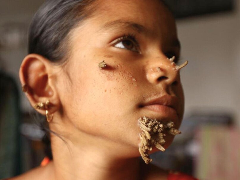 अजीब बीमारी: हाथ-पैर पर उगने लगते हैं 'पेड़-पौधे', हो जाता है बुरा हाल ...