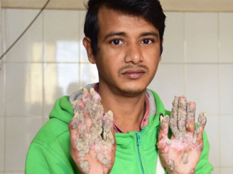 अजीब बीमारी: हाथ-पैर पर उगने लगते हैं 'पेड़-पौधे', हो जाता है बुरा हाल ...