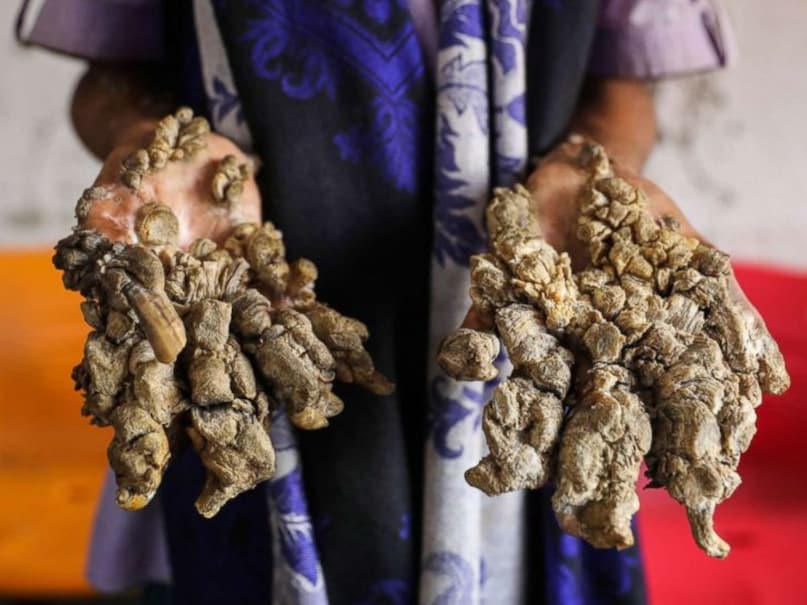 अजीब बीमारी: हाथ-पैर पर उगने लगते हैं 'पेड़-पौधे', हो जाता है बुरा हाल ...