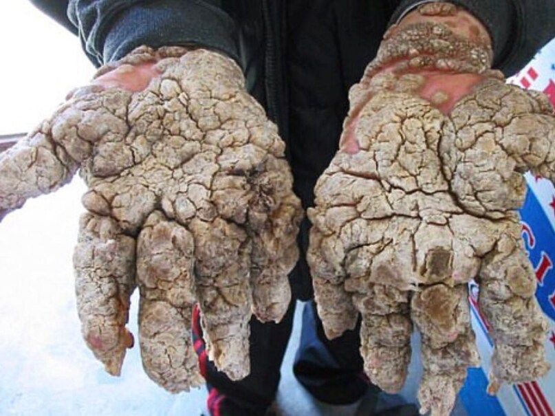 अजीब बीमारी: हाथ-पैर पर उगने लगते हैं 'पेड़-पौधे', हो जाता है बुरा हाल ...