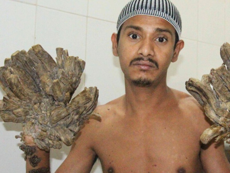 अजीब बीमारी: हाथ-पैर पर उगने लगते हैं 'पेड़-पौधे', हो जाता है बुरा हाल ...