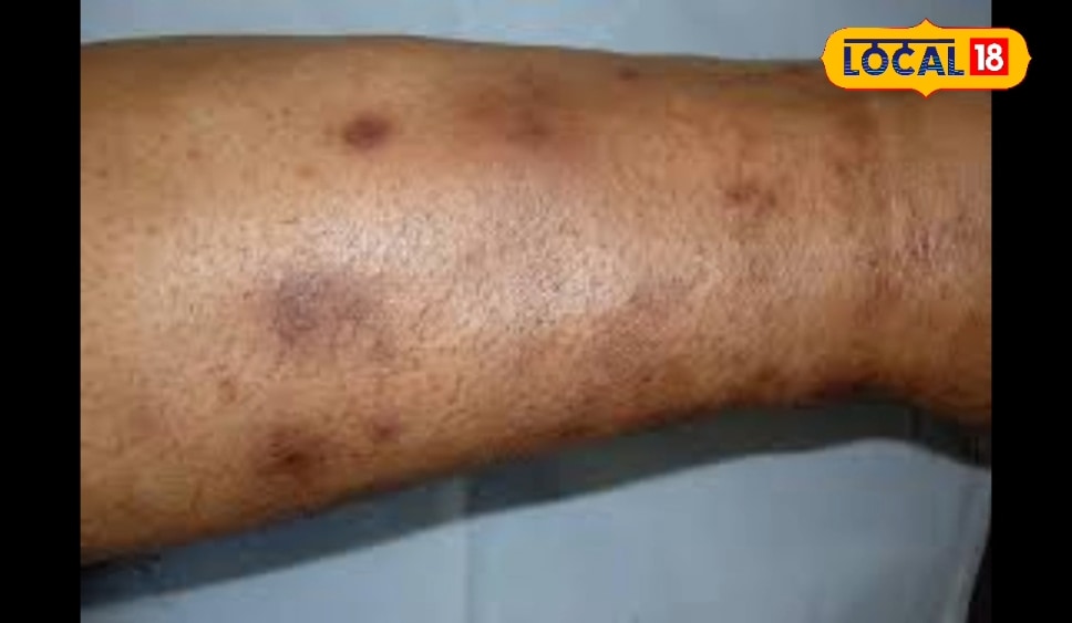 Red patch on knees and elbows means pre diabetes symptoms says Skin ...
