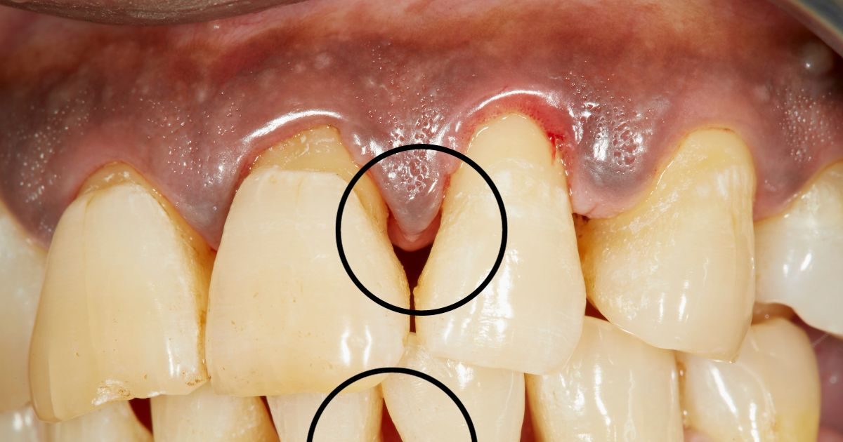 VIDEO: दांतों के बीच काला त्रिकोण है चिंता की बात, डेंटिस्ट ने बताया ...