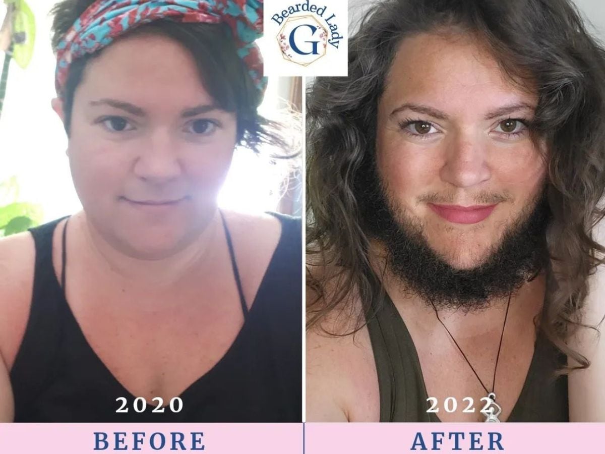 14 साल की लड़की के उगी मूंछ, 40 की होते-होते बढ़ गई दाढ़ी! चेहरे के ...