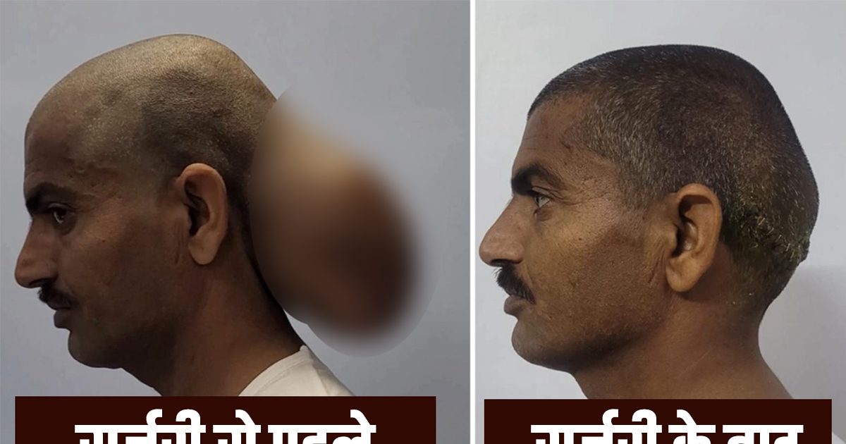 यह शख्स बरसों से 2 सिर लेकर घूम रहा था, देखकर डॉक्टर भी रह गए हैरान ...