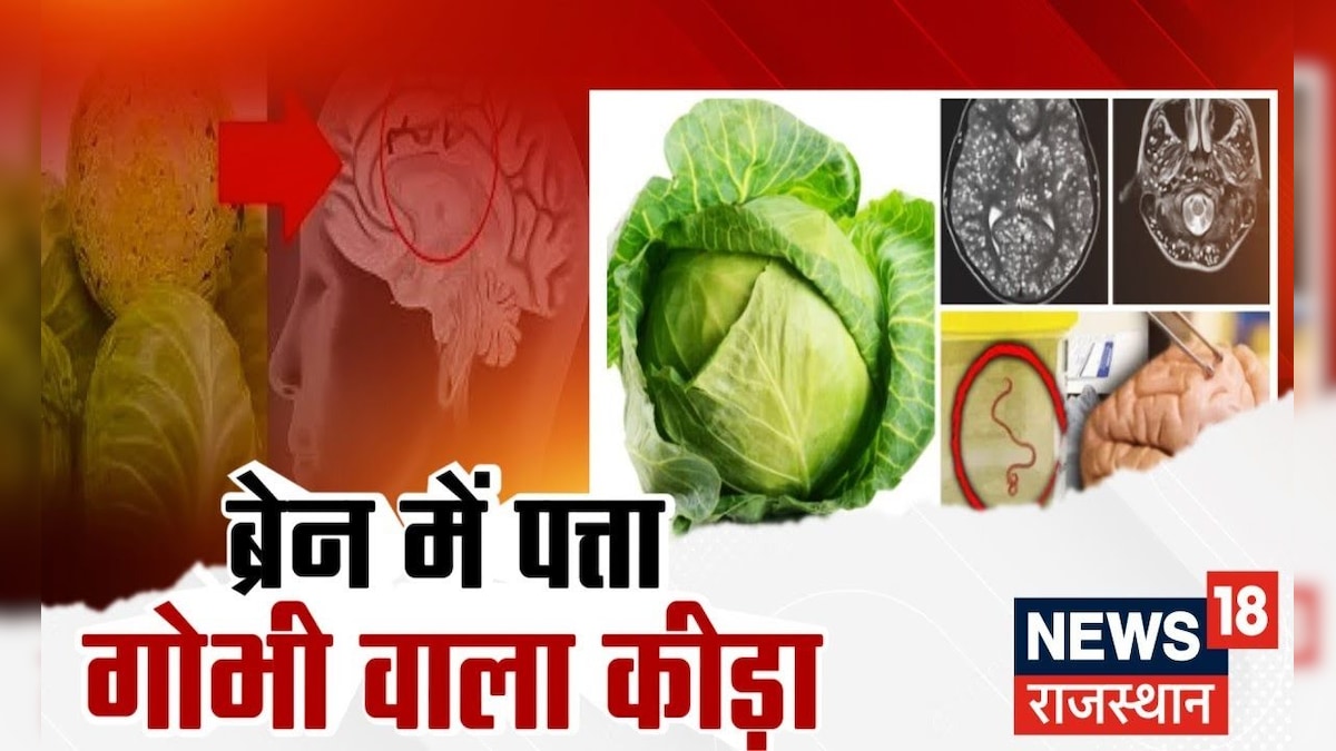 Cabbage Worm in Brain : Migraine से परेशान मरीज के दिमाग में Tapeworm ...
