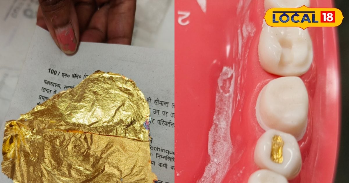 If you want to get gold teeth then know the cost, expert told many ...