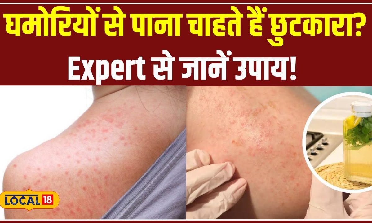 Heat Rash Treatment: दिनभर खुजली और जलन होती है? छुटकारा पाने के लिए ...
