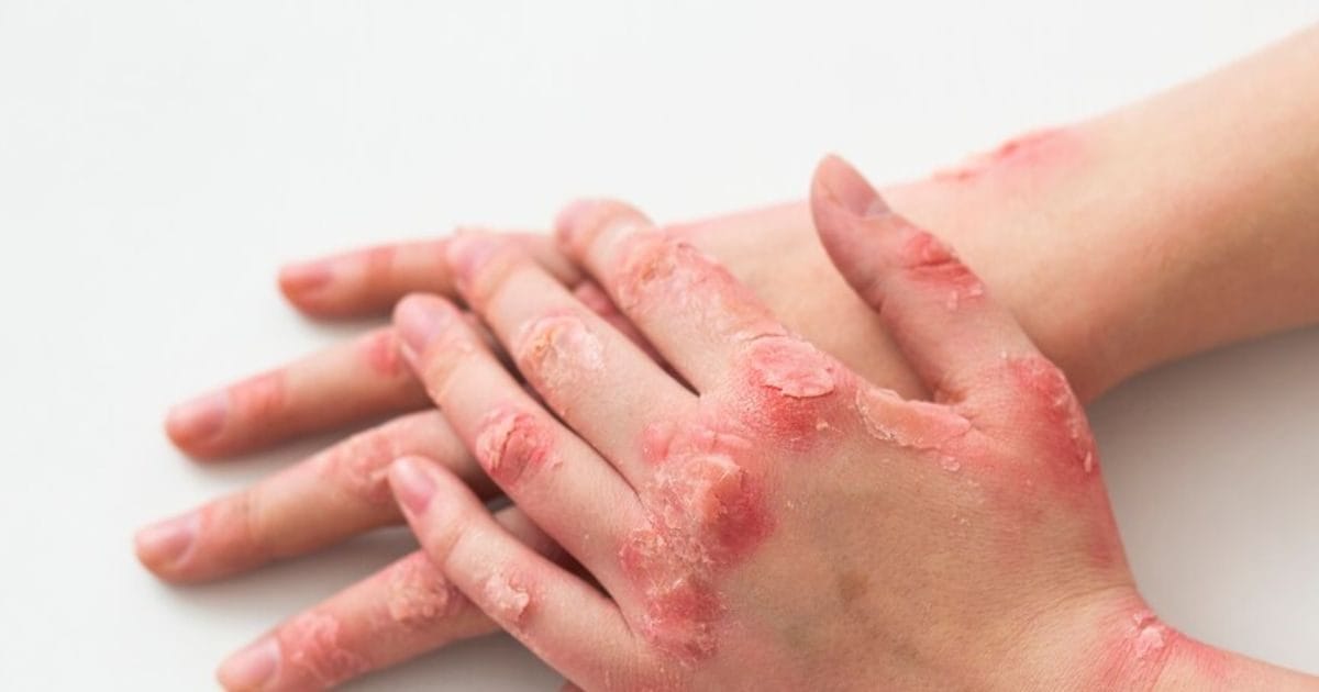 Charm Rog Kyu Hota Hai: सर्दियों में भूलकर भी न करें ये गलती...नहीं तो ...