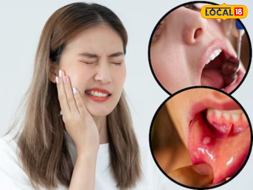 Treatment of sore throat ulcers in hands feet and mouth How to avoid ...