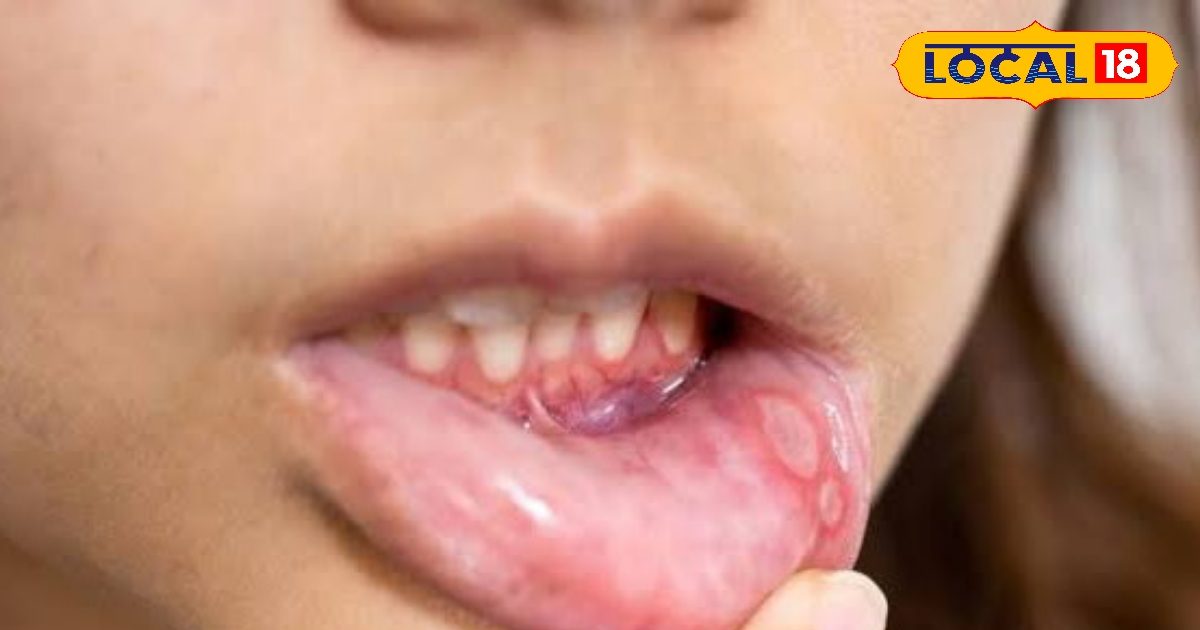 Mouth ulcers occur frequently what causes how to get rid of them know ...