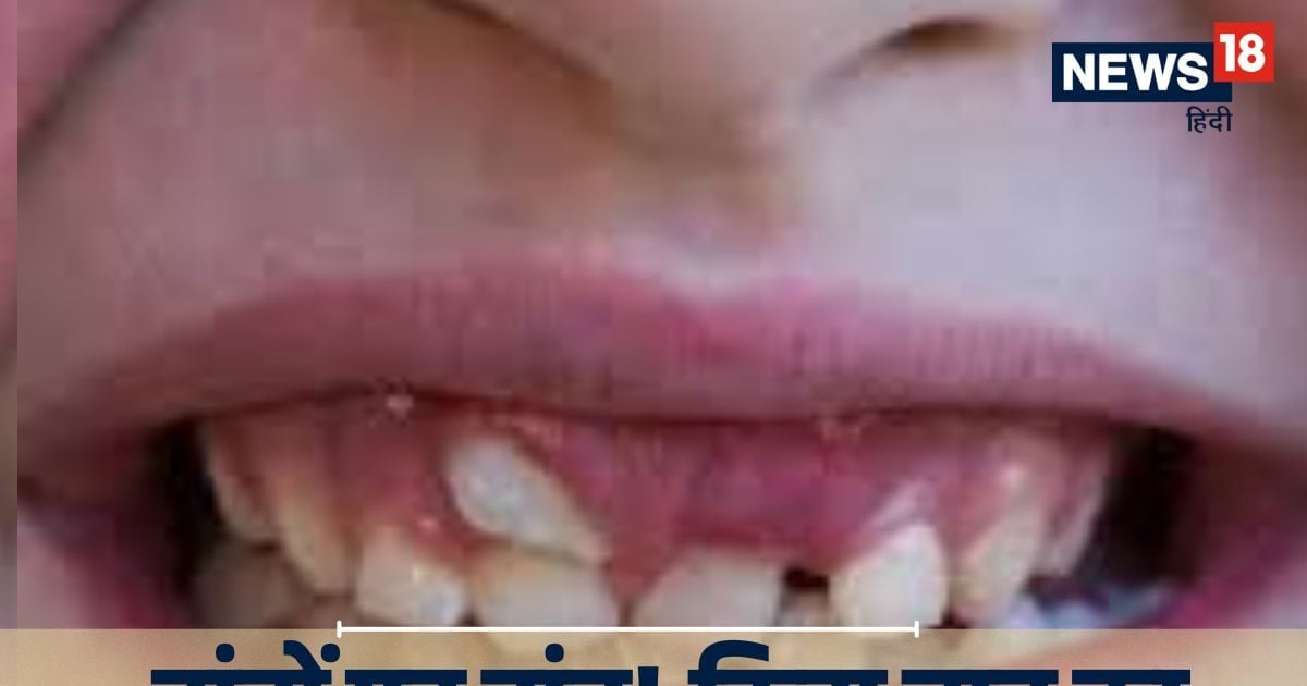 Teeth Astro Tips: क्या आपके भी दांतों पर चढ़ें हैं दांत! जीवन में झेलनी ...