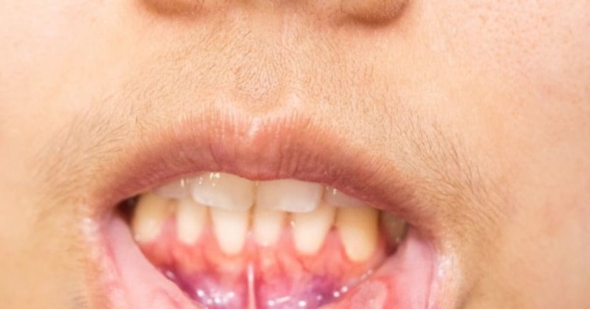 मुंह के छालों को मिनटों में ठीक कर देंगे ये 5 घरेलू उपाय, दर्द से भी ...