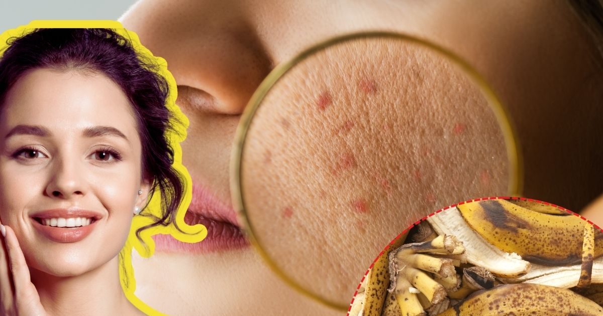 How To Use Banana Peel For Face Glow: केले के छिलके से स्किन केयर ...