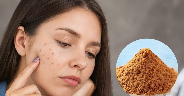 how to get clear skin naturally ayurveda Tips । चेहरे के दाग-धब्बे ...