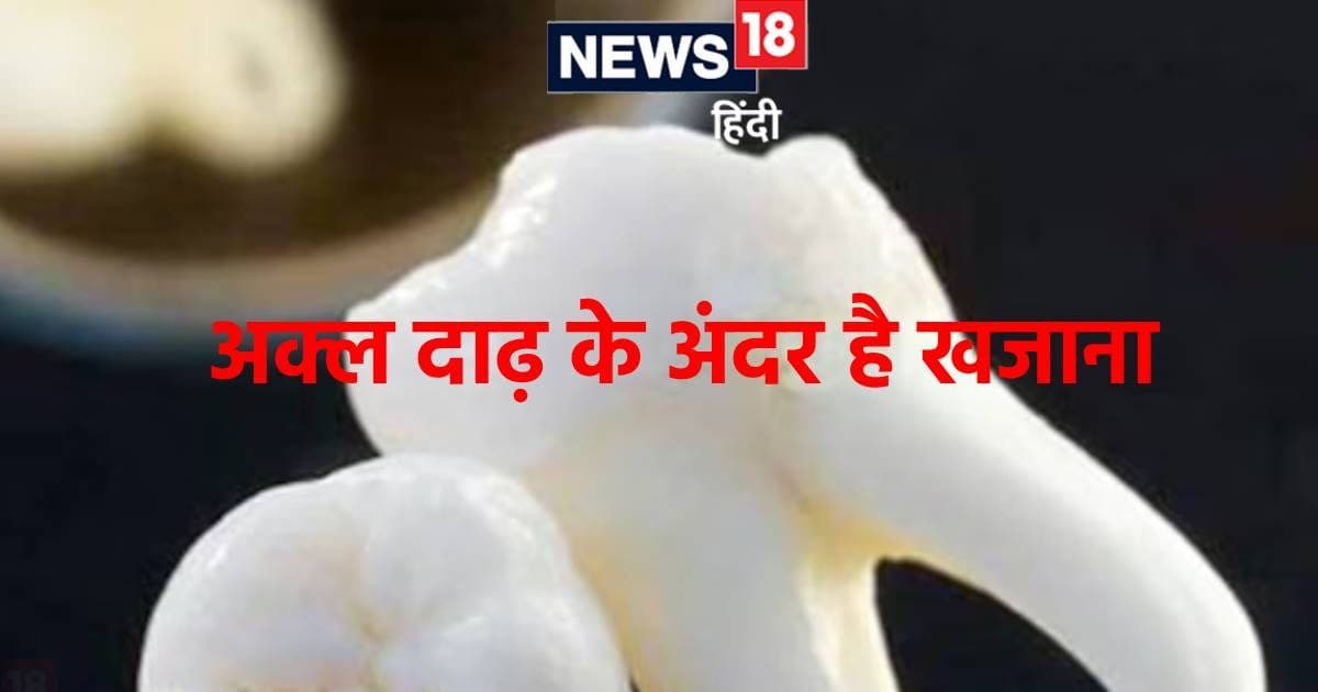 अक्ल दाढ़ में भरा होता है ऐसा खजाना! अब जिससे गंभीर बीमारियों का होगा ...