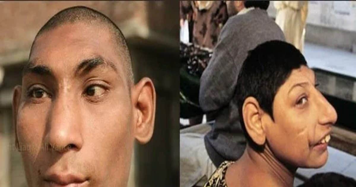 भाई-बहन संग निकाह का नतीजा! पैदा होने लगे ऐसे बच्चे, पाकिस्तान से सामने ...