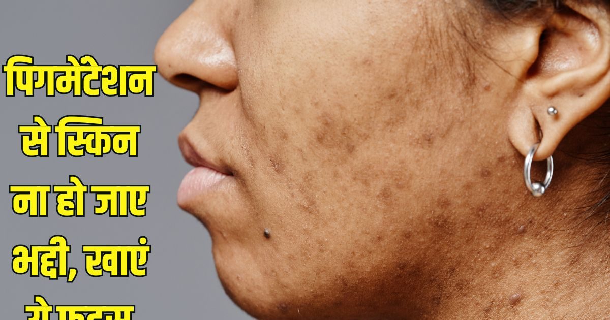 Pigmentation on skin causes foods to reduce: स्किन पिगमेंटेशन में खाएं ...