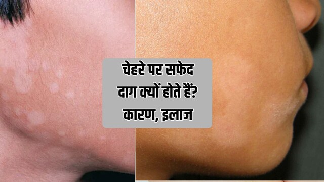 Safed Daag Ka Ilaj| चेहरे पर सफेद दाग क्यों होते हैं? कारण और इलाज ...