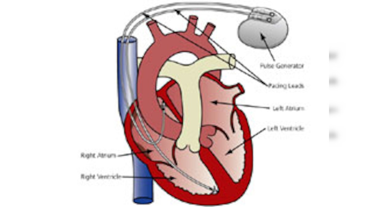 Pacemaker gets an Indian helping hand - News18