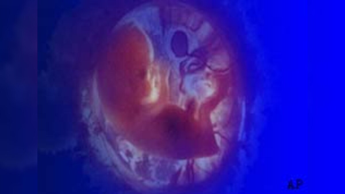 Triplets for woman with two wombs - News18