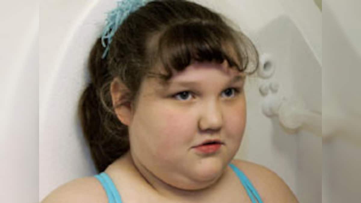 Childhood obesity triggers early puberty - News18