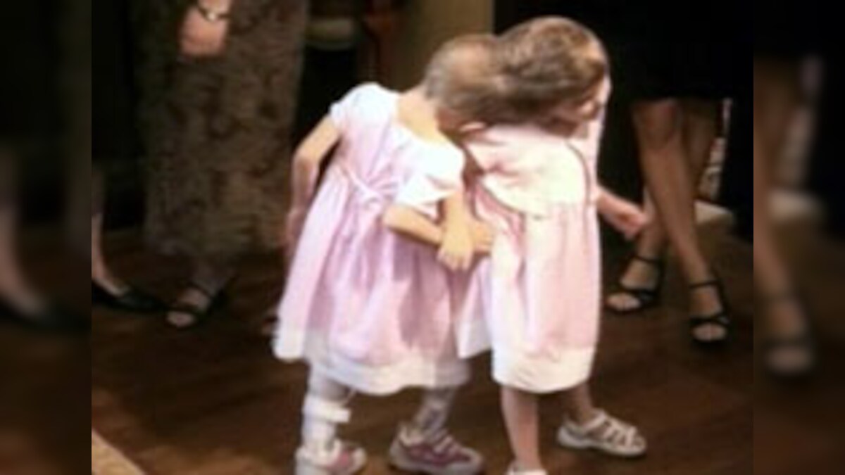 Conjoined Romanian twins can lead normal lives - News18