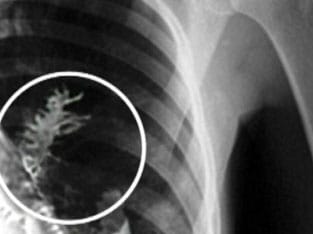 Scientists find plant growing in man's lungs in Russia - News18
