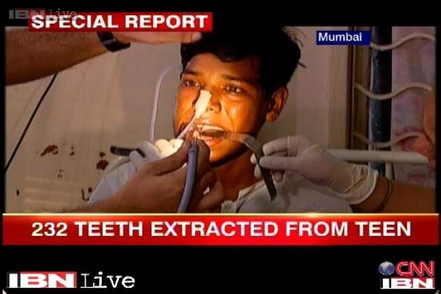 Mumbai: Doctors baffled after extracting 232 teeth from a 17-year-old's ...