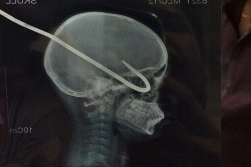 Hyderabad Doctors Remove Iron Rod From Boy's Eyeball, Skull - News18