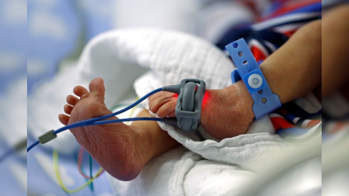 Baby 'Born Twice' After Miracle Surgery In US - News18