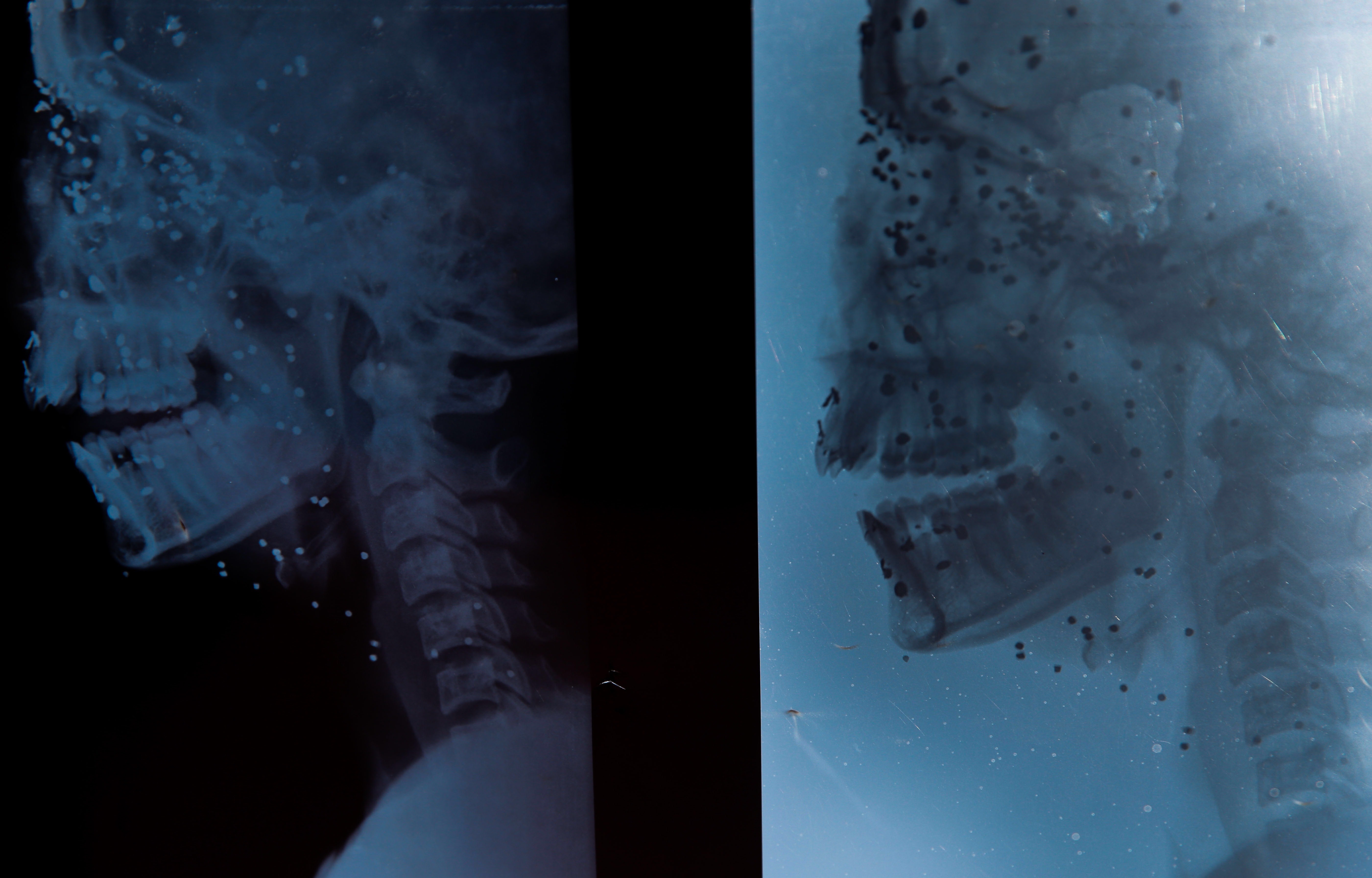 Insha, Who Lost Her Vision to Pellet Guns, is Angry Yet Hopeful - News18