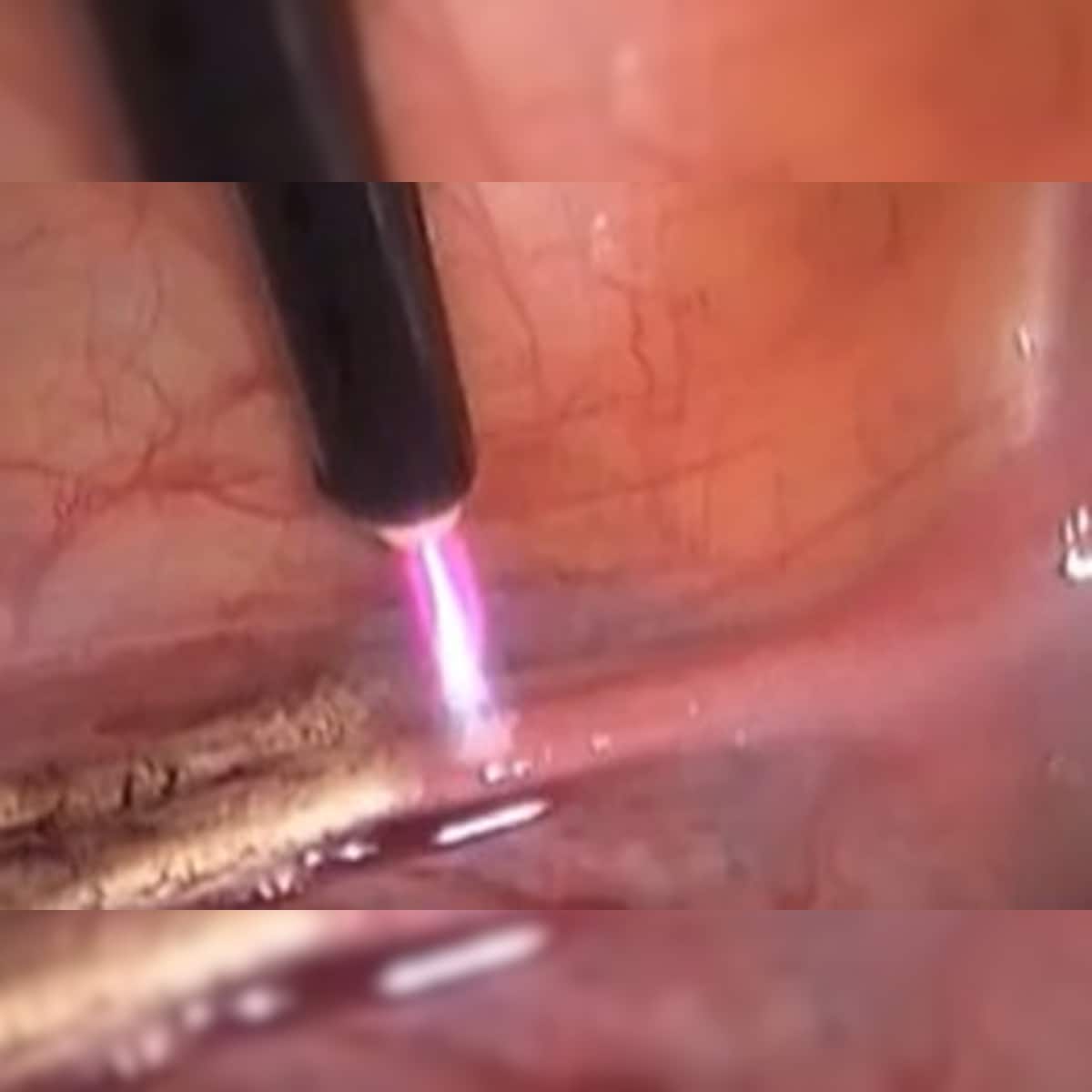 Argon Beam Coagulator Liver - The Best Picture Of Beam