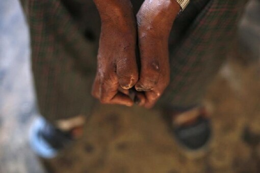 India Isn't Leprosy Free Yet: Health Campaign Data Shows Rise In ...