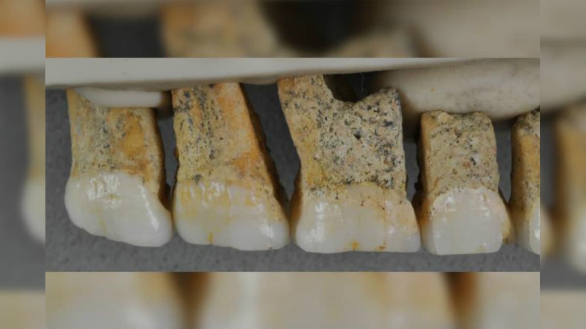 Tooth Found Growing inside Man's Nostrils for Years after He Complains ...