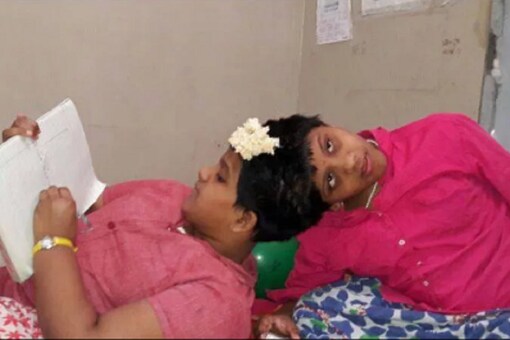 Twin Test for Telangana Authorities as Conjoined Sisters Prepare for ...
