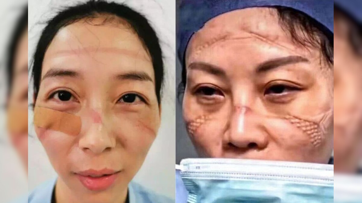 Nurses Treating Coronavirus Patients Have Been Left with Marks on Faces ...