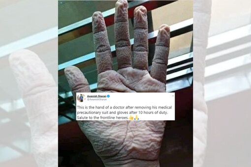 Photo of Doctor's Pruney Hand After Wearing Gloves for 10 Hours Amid ...